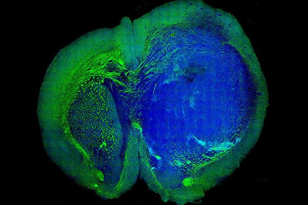 Lasering in on tumors — Harvard Gazette
