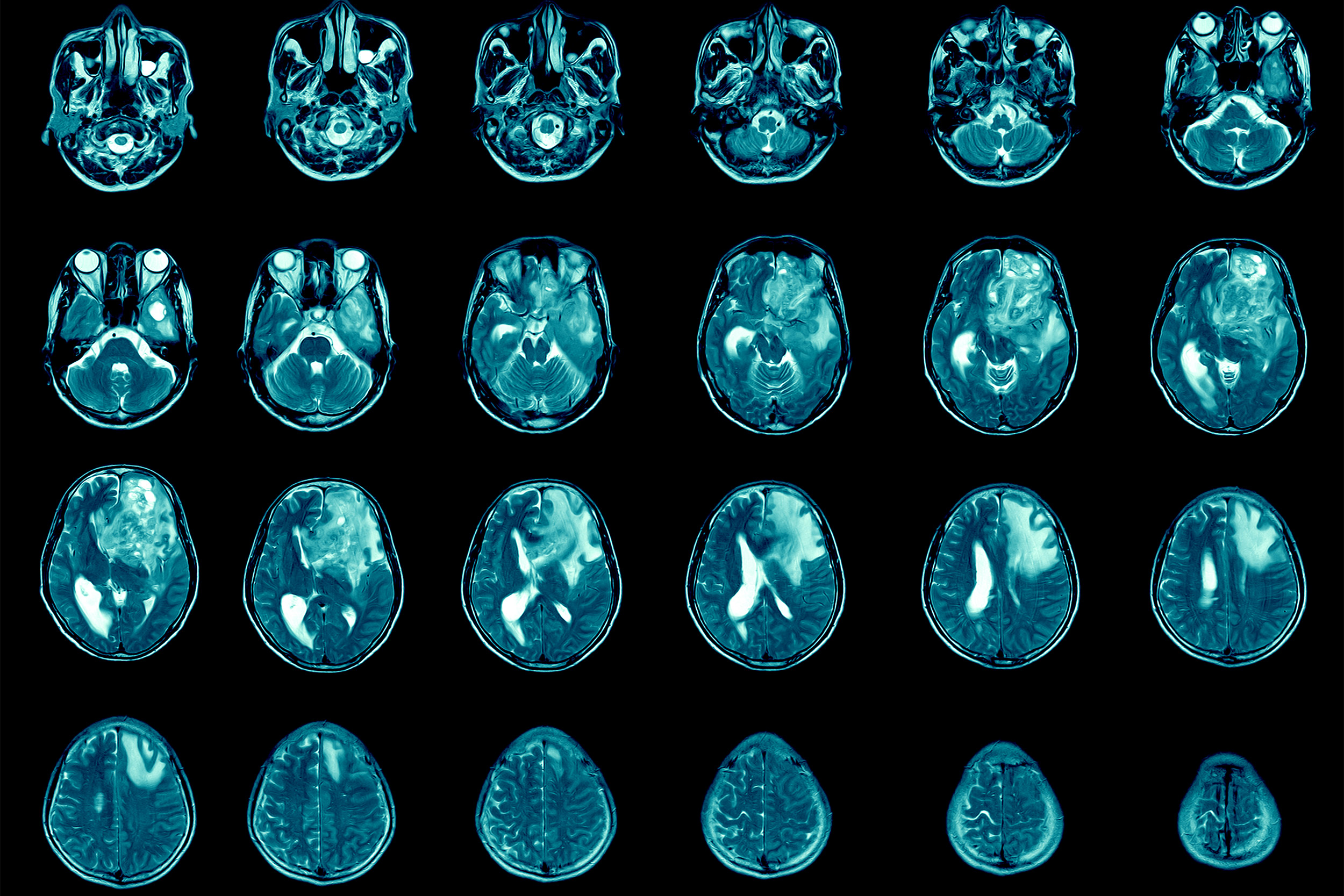 ‘Dramatic’ inroads against aggressive brain cancer— Harvard Gazette